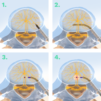 Intracept Procedure - Pain Care Boise